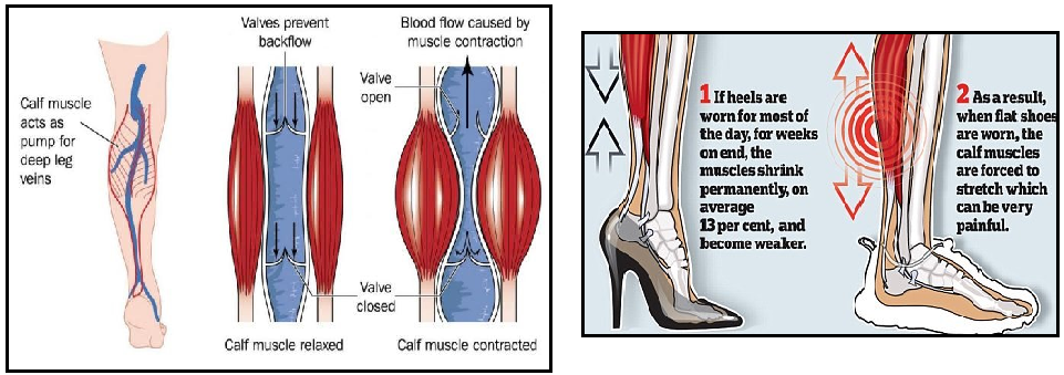 The most probable reason for tight calves is… – Micro Training